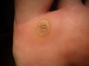 Verrucae – Kent Foot & Ankle Clinic