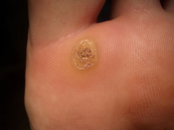 Verrucae – Kent Foot & Ankle Clinic